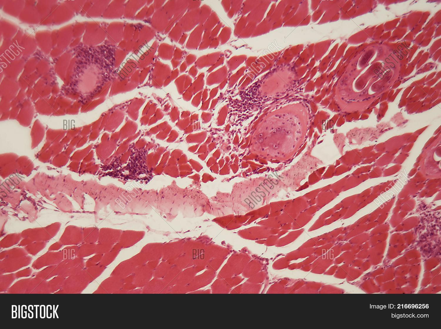 Trichinella Spiralis Larvae In Muscle Tissue Under The Microscope ...