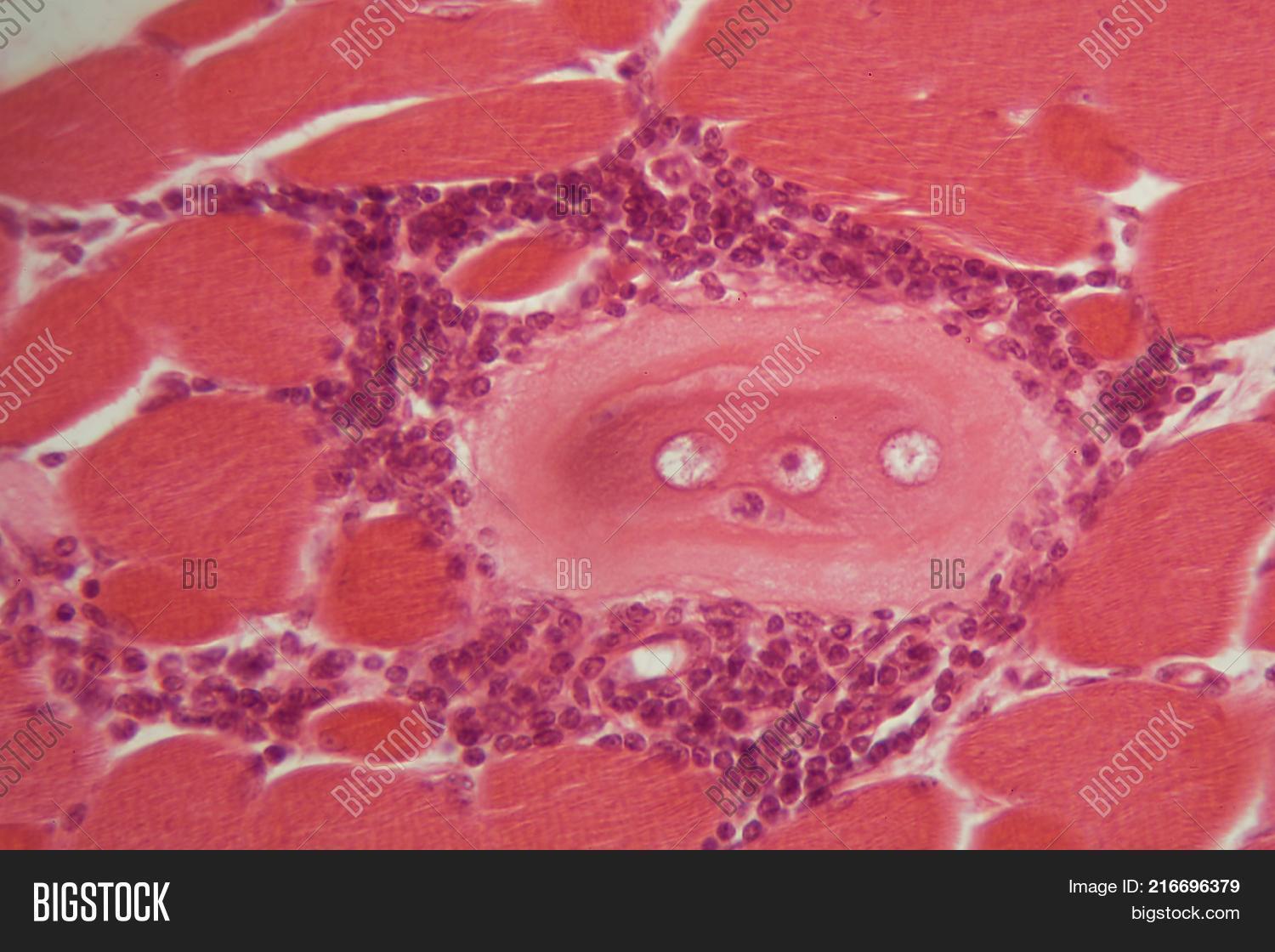 Trichinella Spiralis Larvae In Muscle Tissue Under The Microscope ...