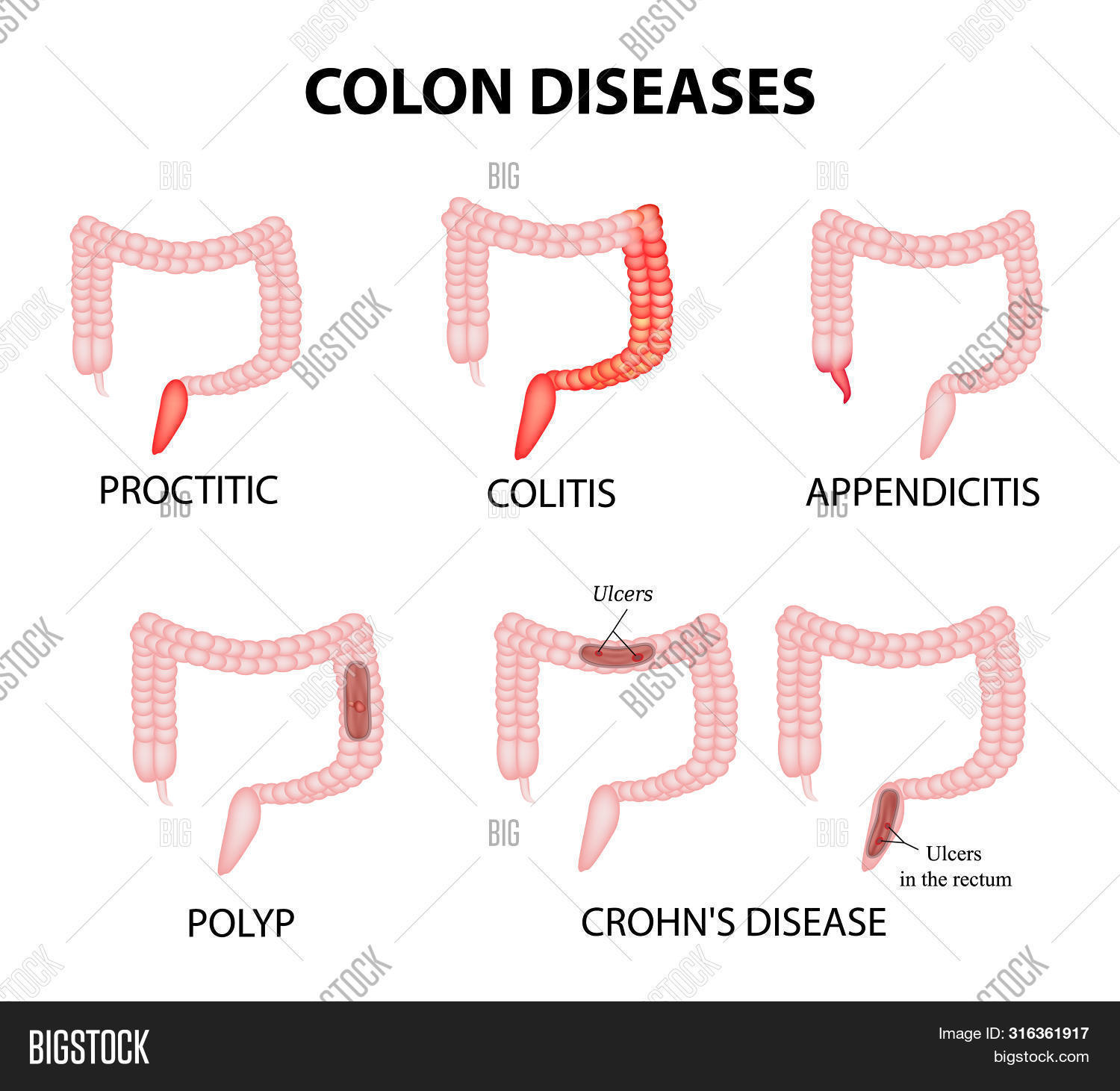 Colon Diseases. Proctitis, Colitis, Appendicitis, Polyp, Ulcer, Crohns ...