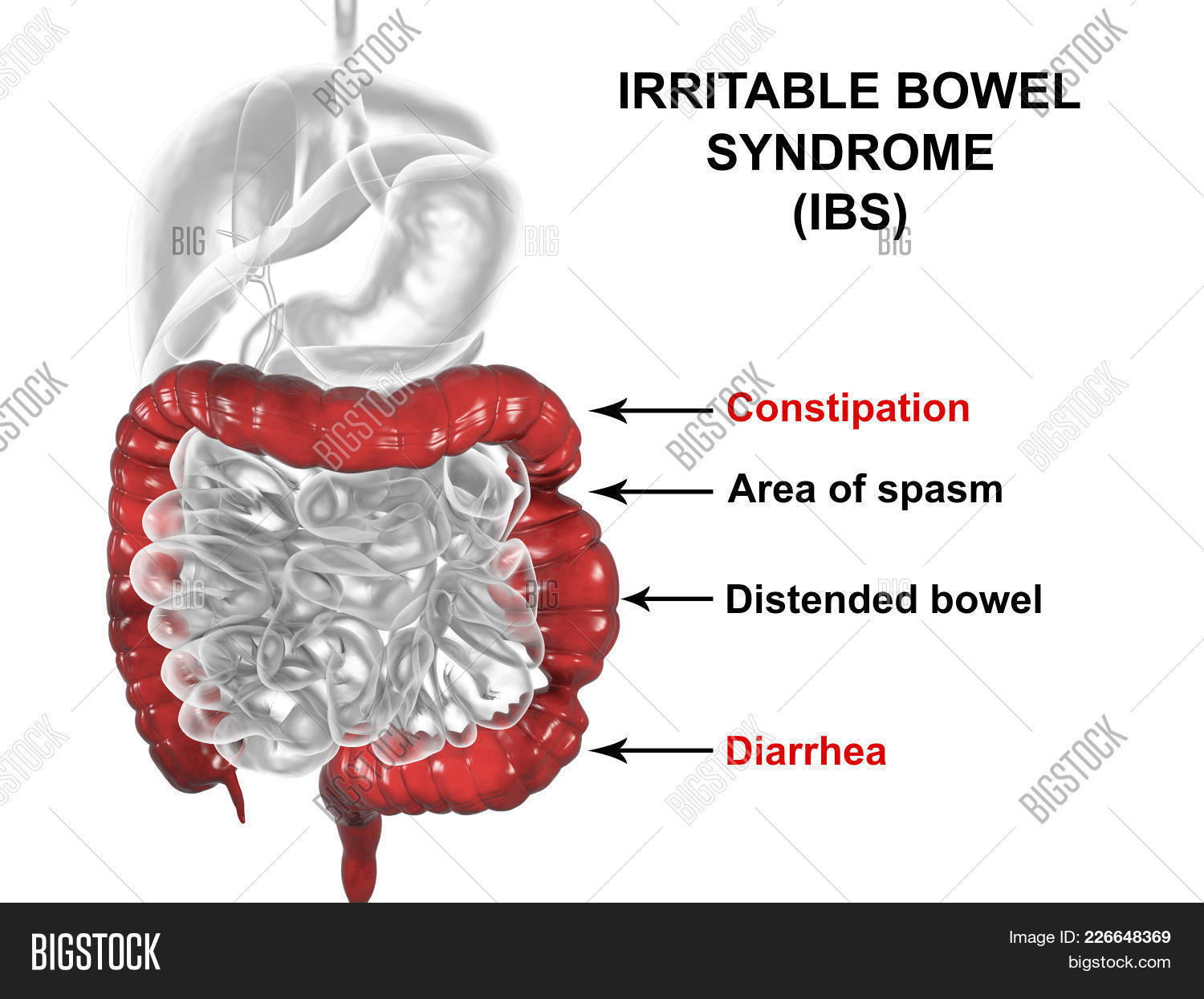 Irritable Bowel Syndrome Ibs Medical Concept, 3d Illustration Showing ...