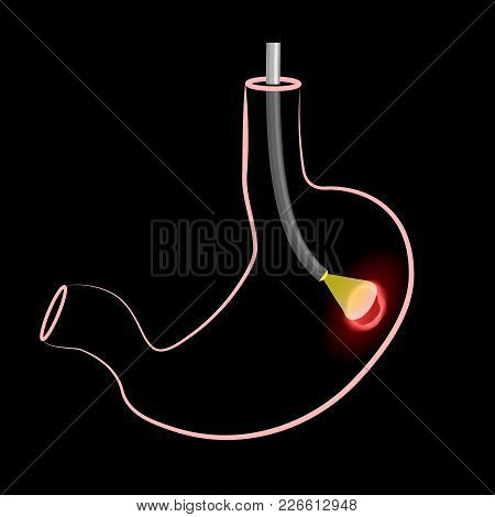 Gastroscopy Procedure. Human Stomach With Peptic Ulcer, And Endoscopic ...