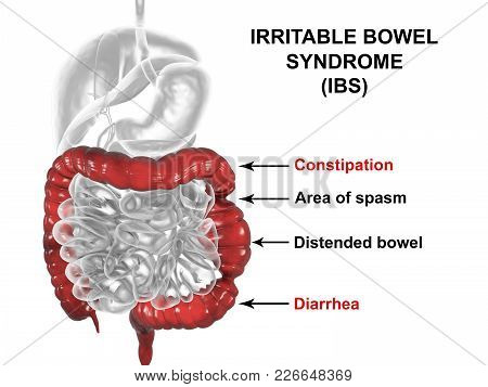 Irritable Bowel Syndrome Ibs Medical Concept, 3d Illustration Showing ...