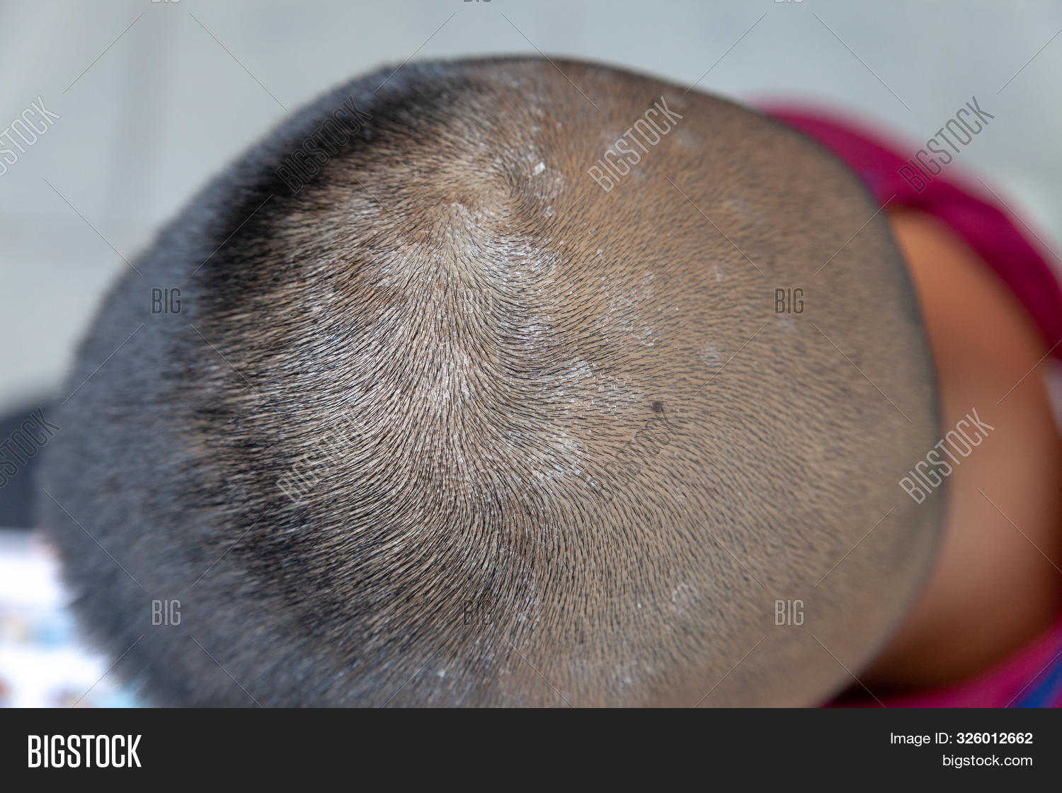 Close-up Skin Head , Scalp, Photos Of Dermatitis And Eczema, Skin ...