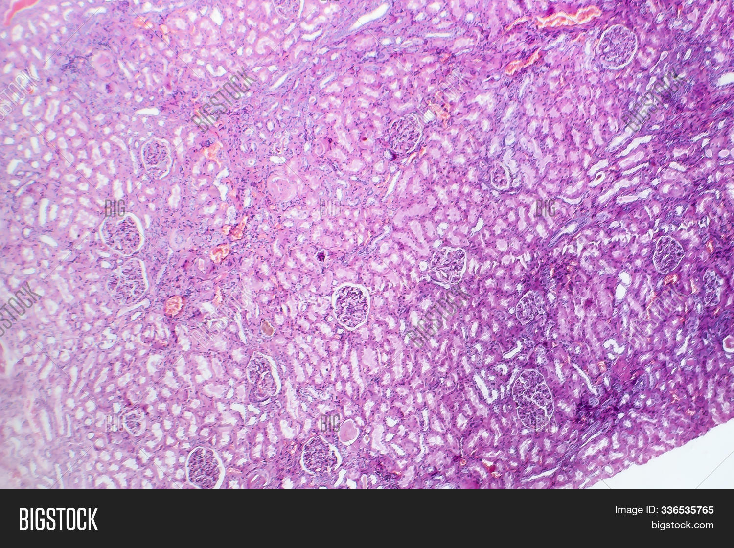 Histopathology Of Hypertensive Renal Disease, Light Micrograph, Photo ...