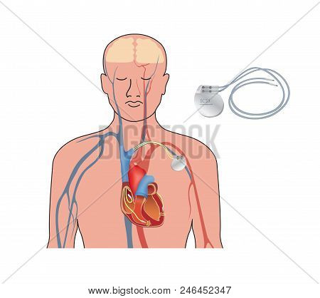 Heart Pacemaker. Human Heart Anatomy Cross Section With Working ...
