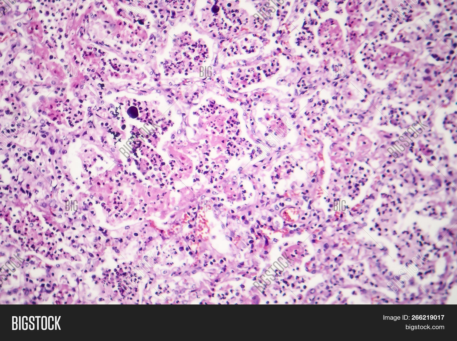 Lobar Pneumonia, Red Hepatic Phase, Light Micrograph, Photo Under ...