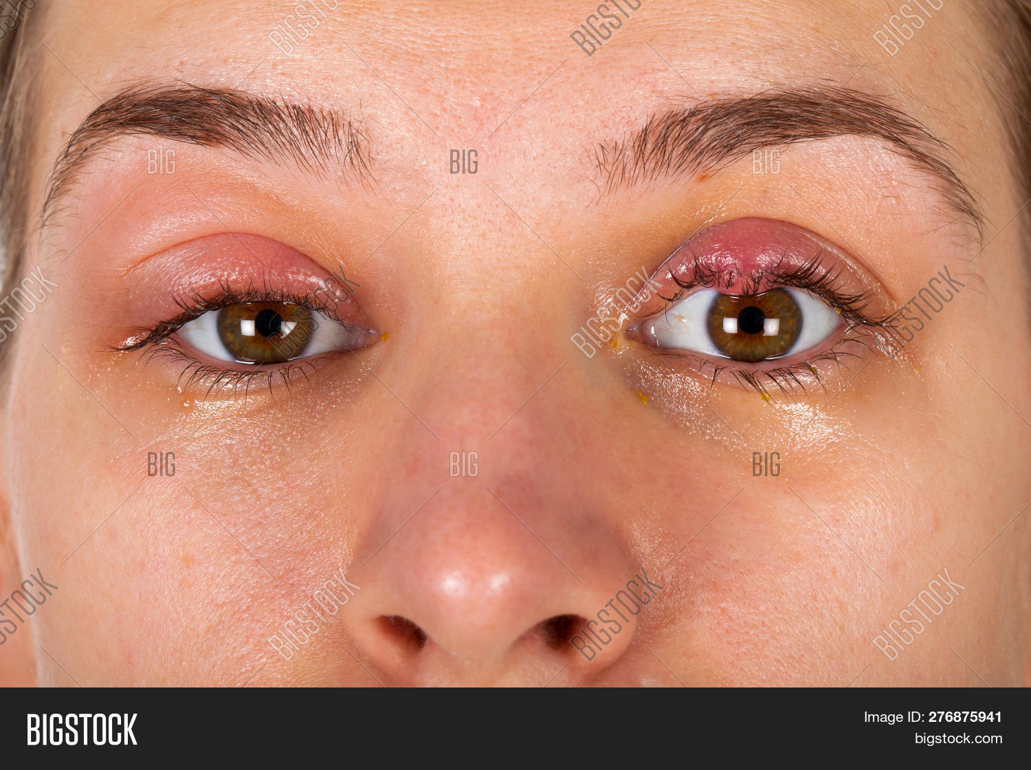 Close Up Picture Of Upper Eyelid Inflammation - Chalazion - Young ...
