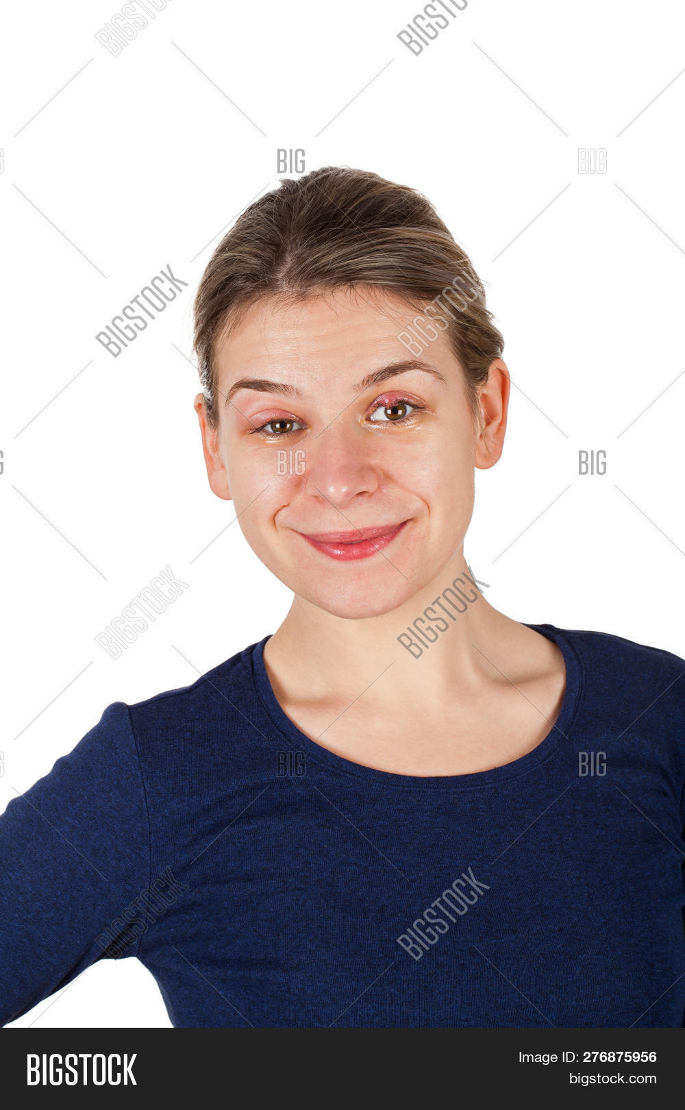 Young Female Suffering From Chalazion - Upper Eyelid Inflammation ...