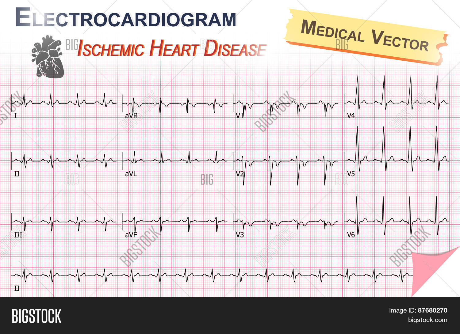 Electrocardiogram ( Ecg , Ekg ) Of Ischemic Heart Disease ( Myocardial ...