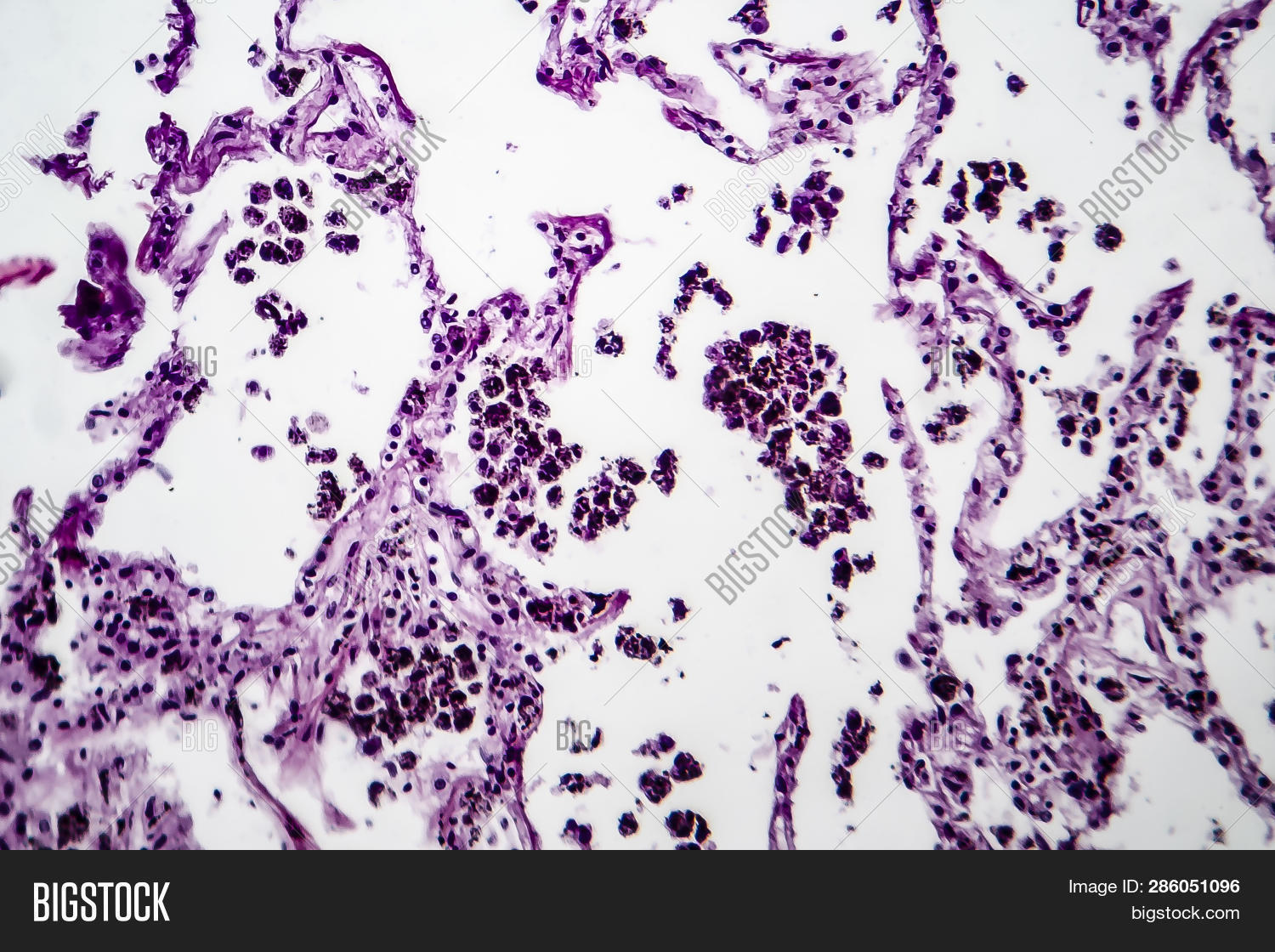 Histopathology Of Lung Emphysema, Light Micrograph, Photo Under ...
