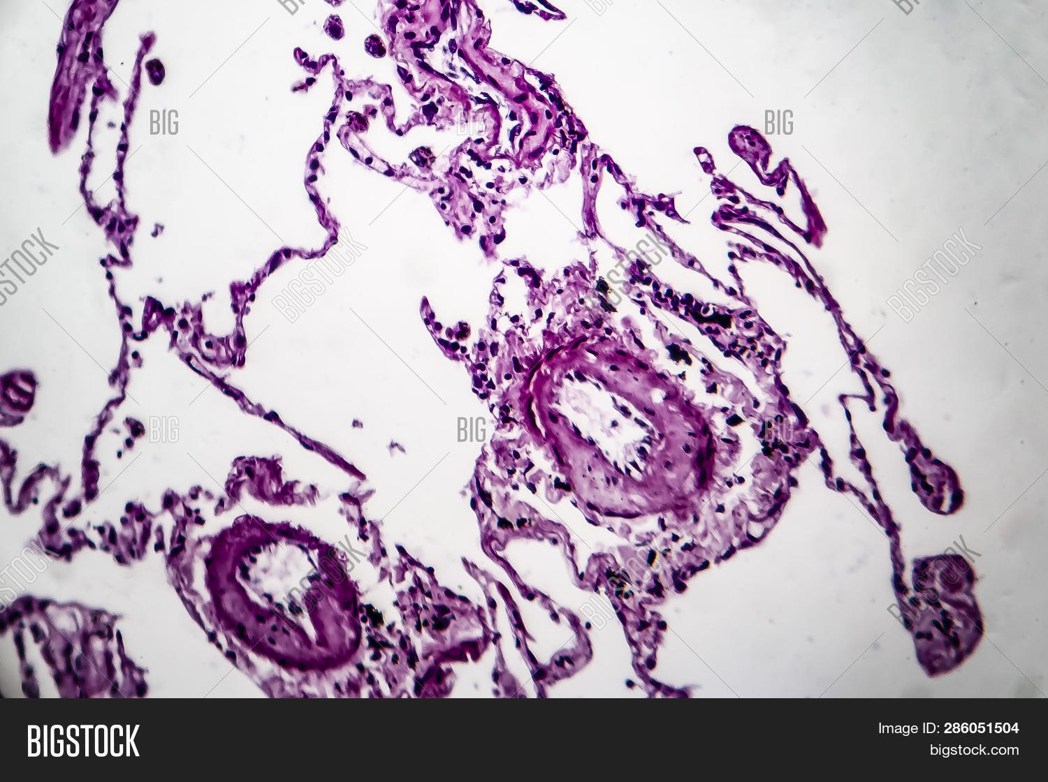 Histopathology Of Lung Emphysema, Light Micrograph, Photo Under ...