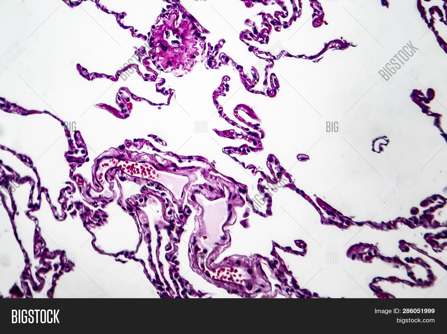 Histopathology Of Lung Emphysema, Light Micrograph, Photo Under ...