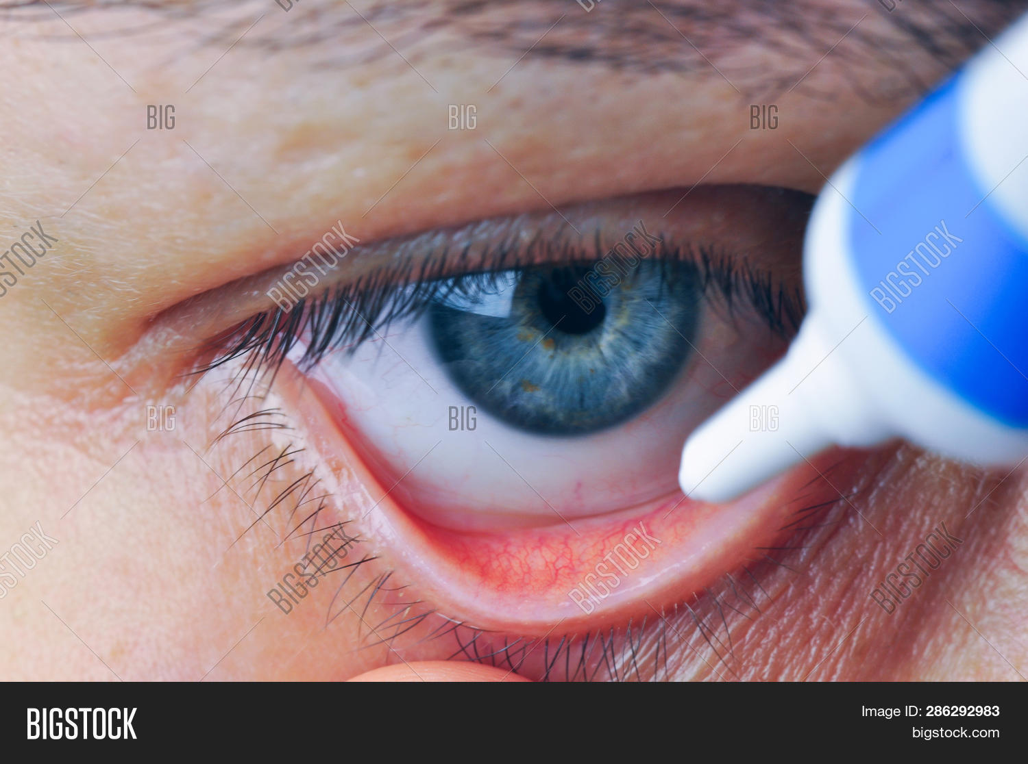 Implementation Drug In Conjunctival Sac. Instill Eye Ointment. image ...