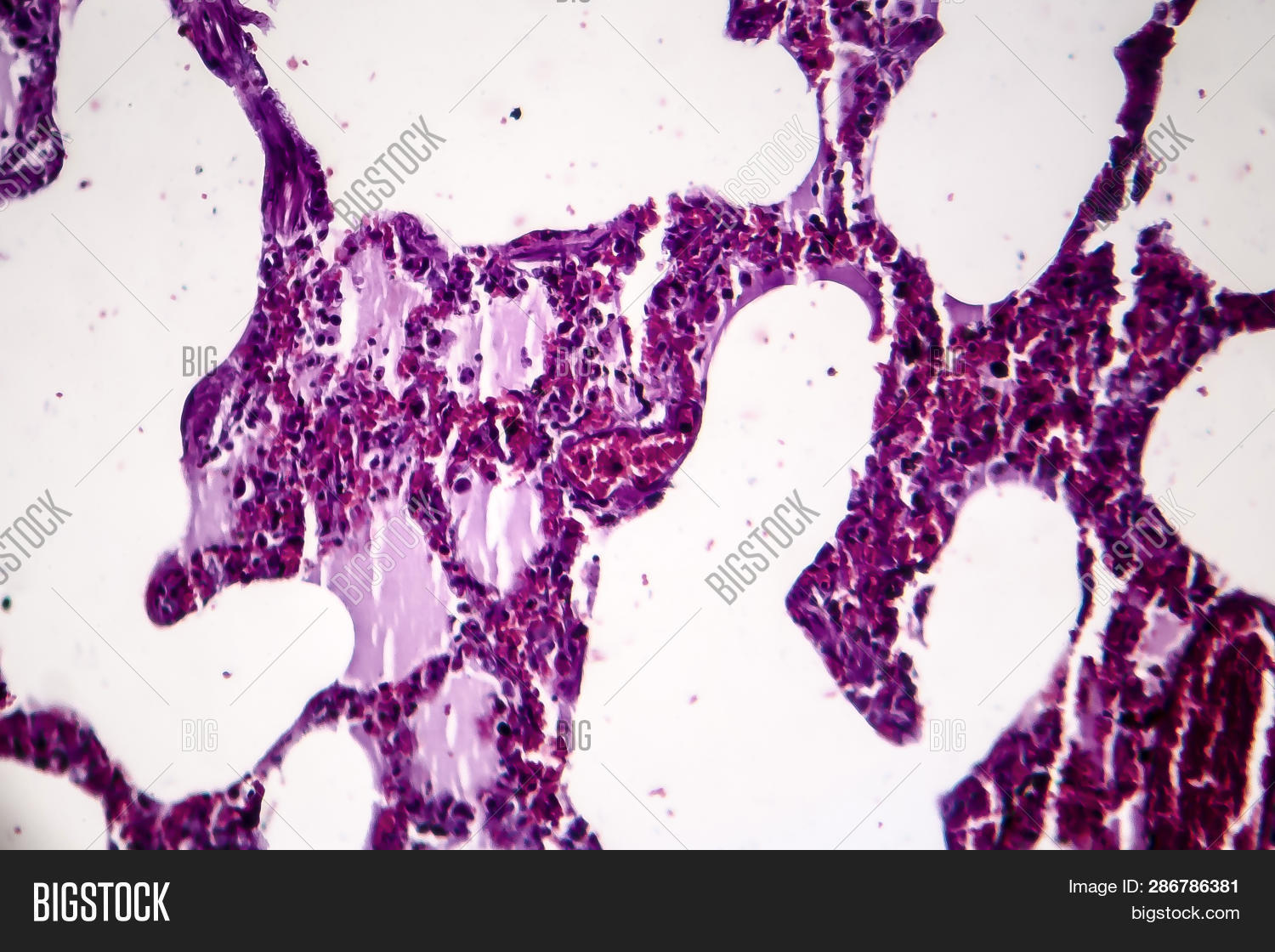 Histopathology Of Pneumonia, Light Micrograph, Photo Under Microscope ...