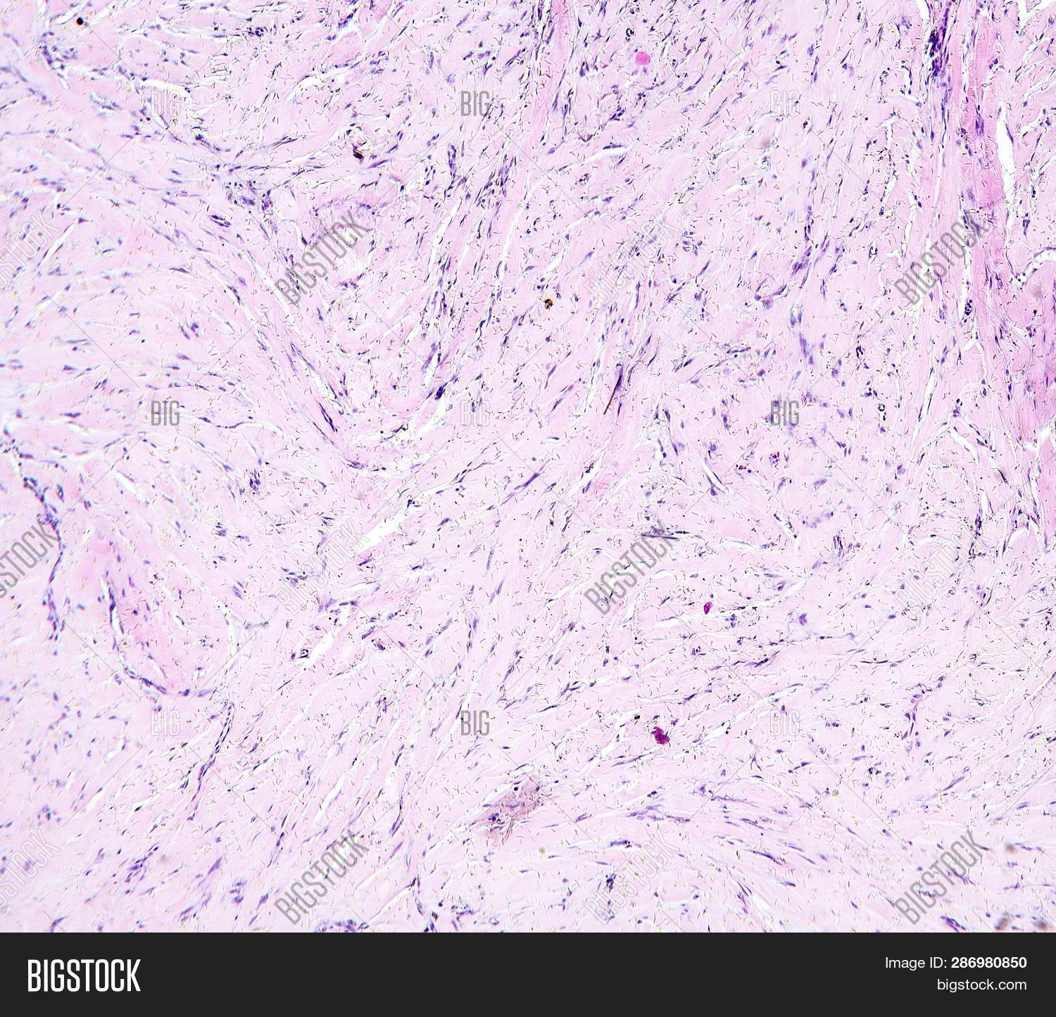 Histology Of Human Tissue, Show Connective Tissue, Hyaline Degeneration ...