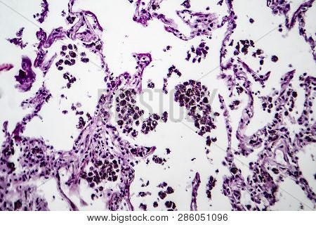 Histopathology Of Lung Emphysema, Light Micrograph, Photo Under ...