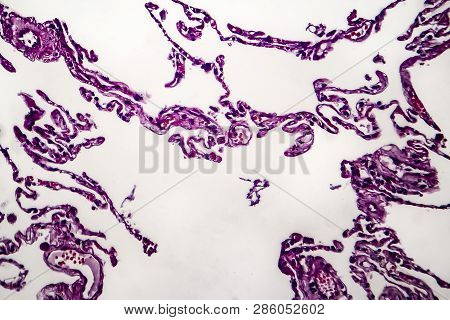Histopathology Of Lung Emphysema, Light Micrograph, Photo Under ...