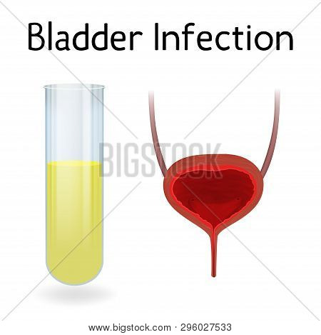 Anatomy Picture Of Bladder Infection, Cystitis. Tube With Urinary ...