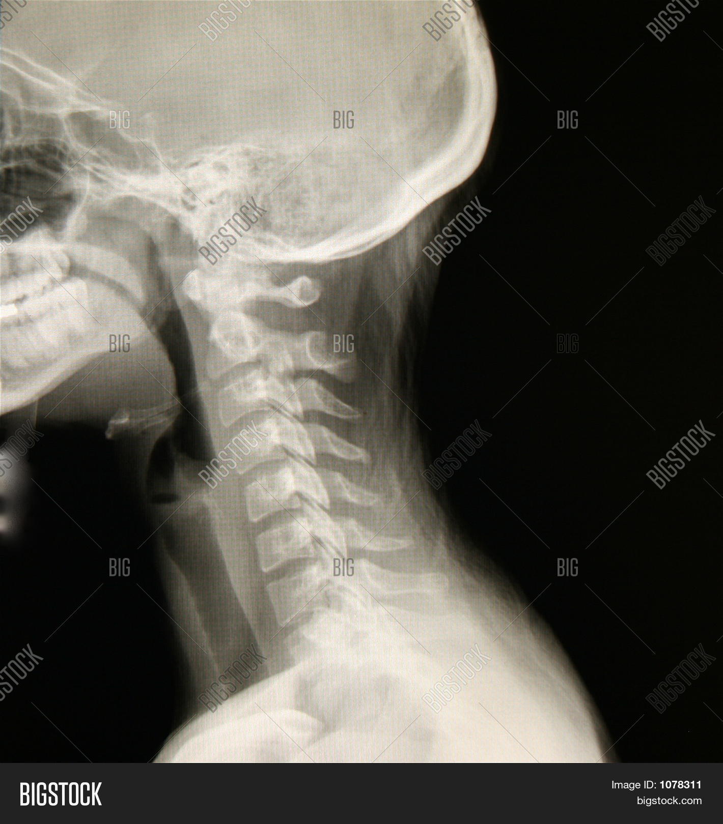 Neck / Cervical Spine Xray image & stock photo. 1078311