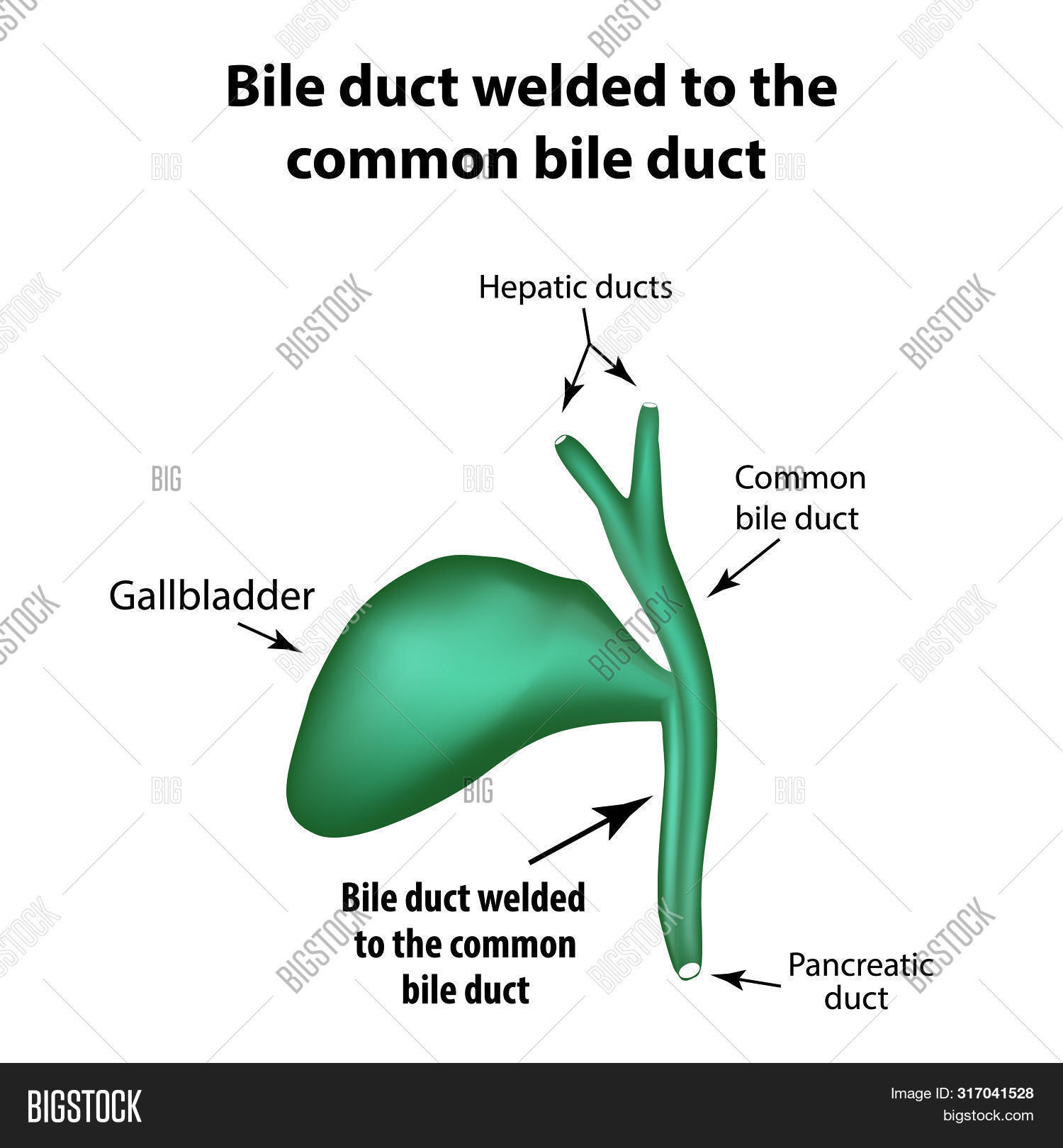 Bile Duct Welded To The Common Bile Duct. Pathology Of The Gallbladder ...