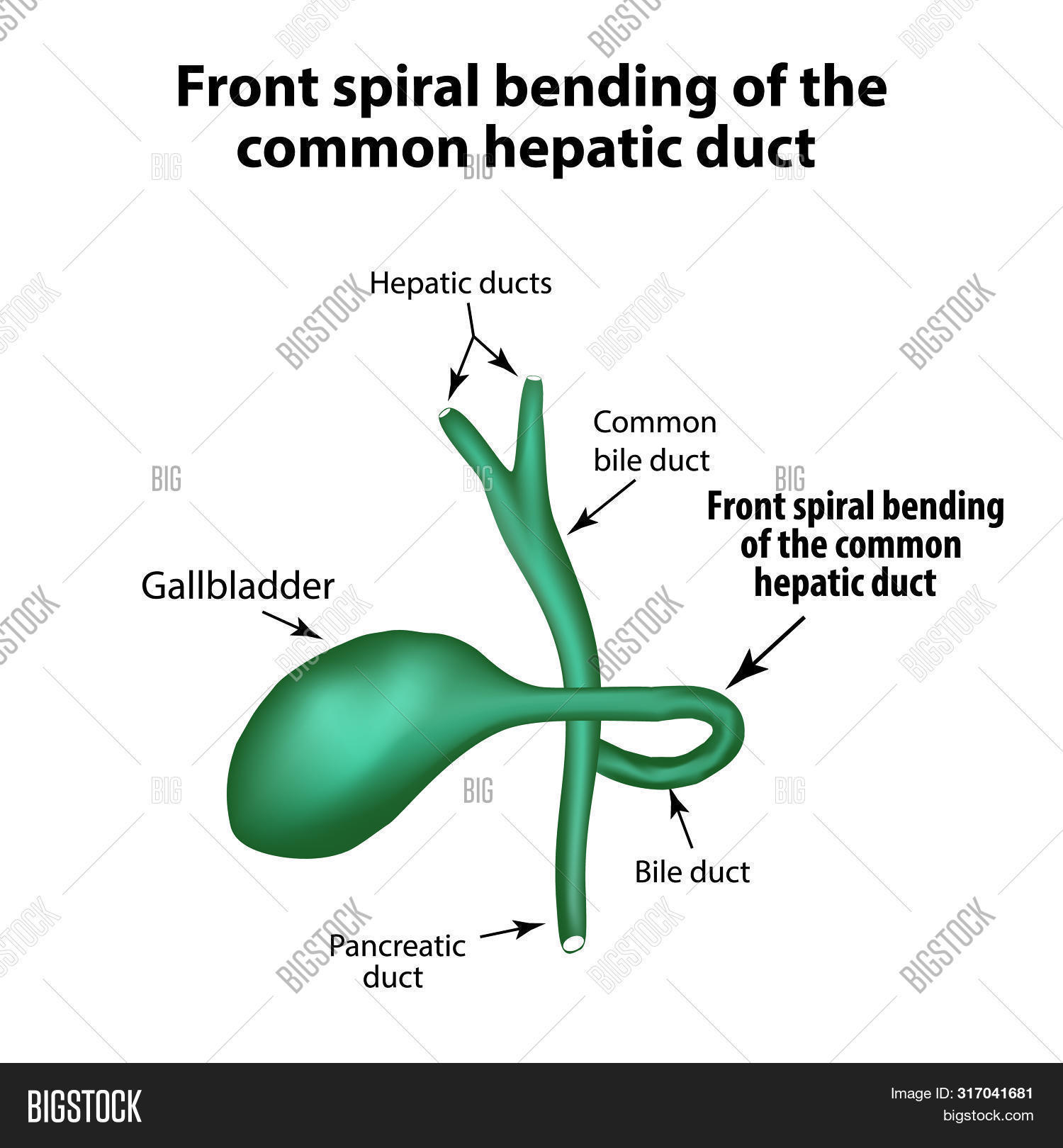 Front Spiral Bending Of The Common Hepatic Duct. Pathology Of The ...