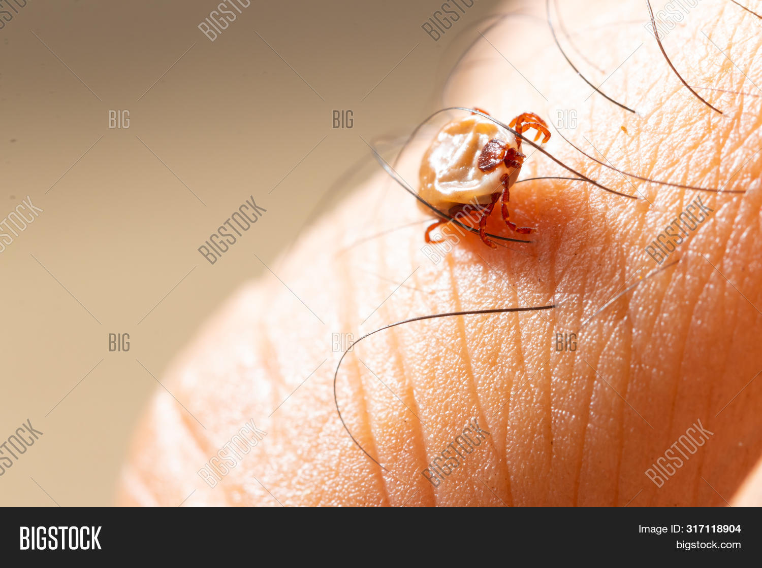 Tick Filled With Blood Sitting On Human Skin. image & stock photo ...