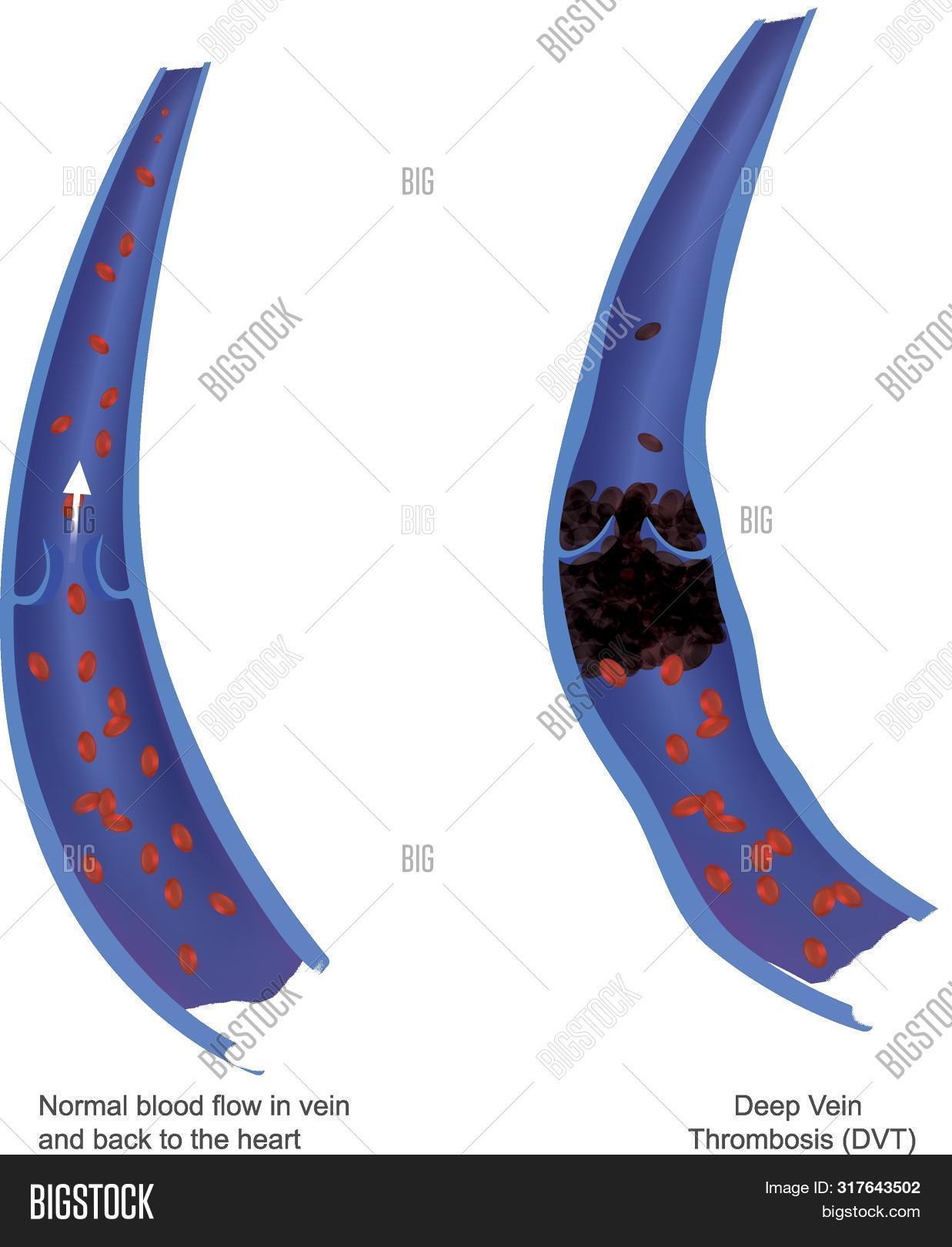 Deep Vein Thrombosis. In Normal Conditions Red Blood Cell Flow In Vein ...
