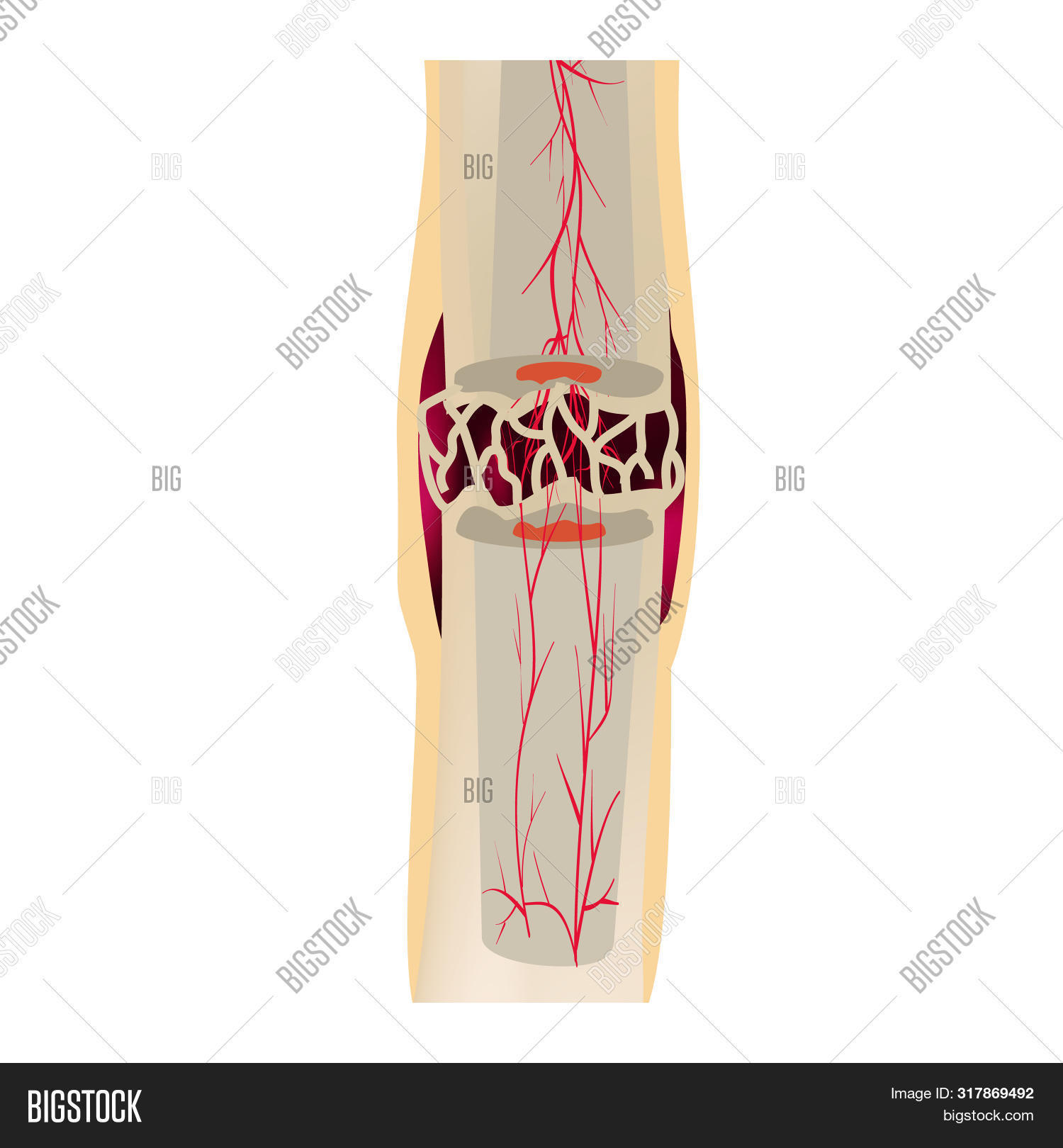 3 Stage Of Healing Bone Fracture. Callus Ossification. The Bone ...