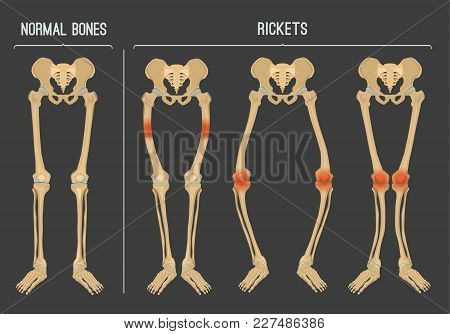 Normal Bones Versus Rickets And Osteomalacia. Types Of Disease. Medical ...
