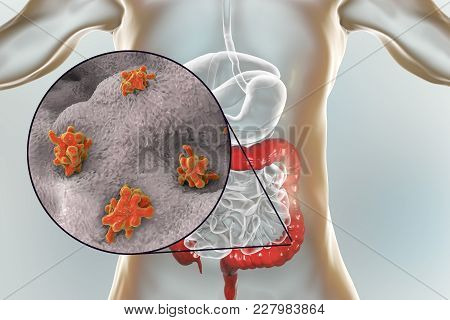 Entamoeba Histolytica Protozoan Infection Of Large Intestine. Parasite ...