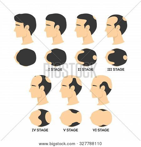 Alopecia Stages Set. Hair Loss, Balding Process. Male image & stock ...