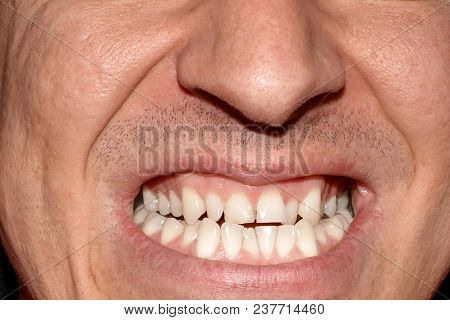 Ugly Teeth With Terrible Smile. Portrait Of Close Up Man With Crooked ...