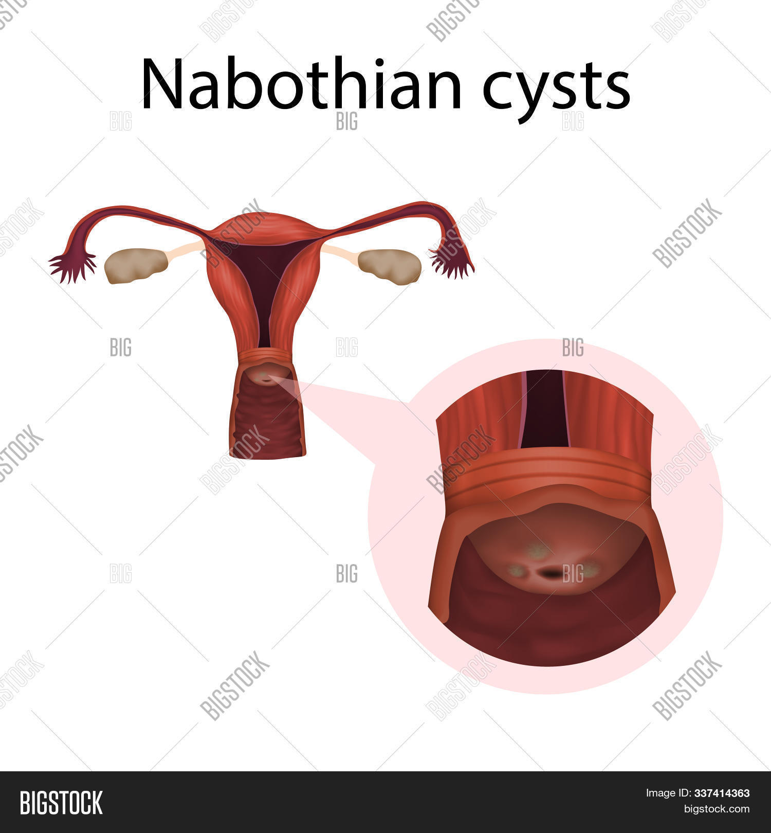 Nabothian Cysts. Cervical Disease. Medical Anatomy Illustration. image ...