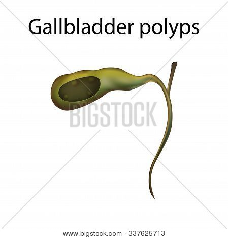 Gallbladder Polyps. Abnormal Growth Of Tissue. Medical Anatomy ...