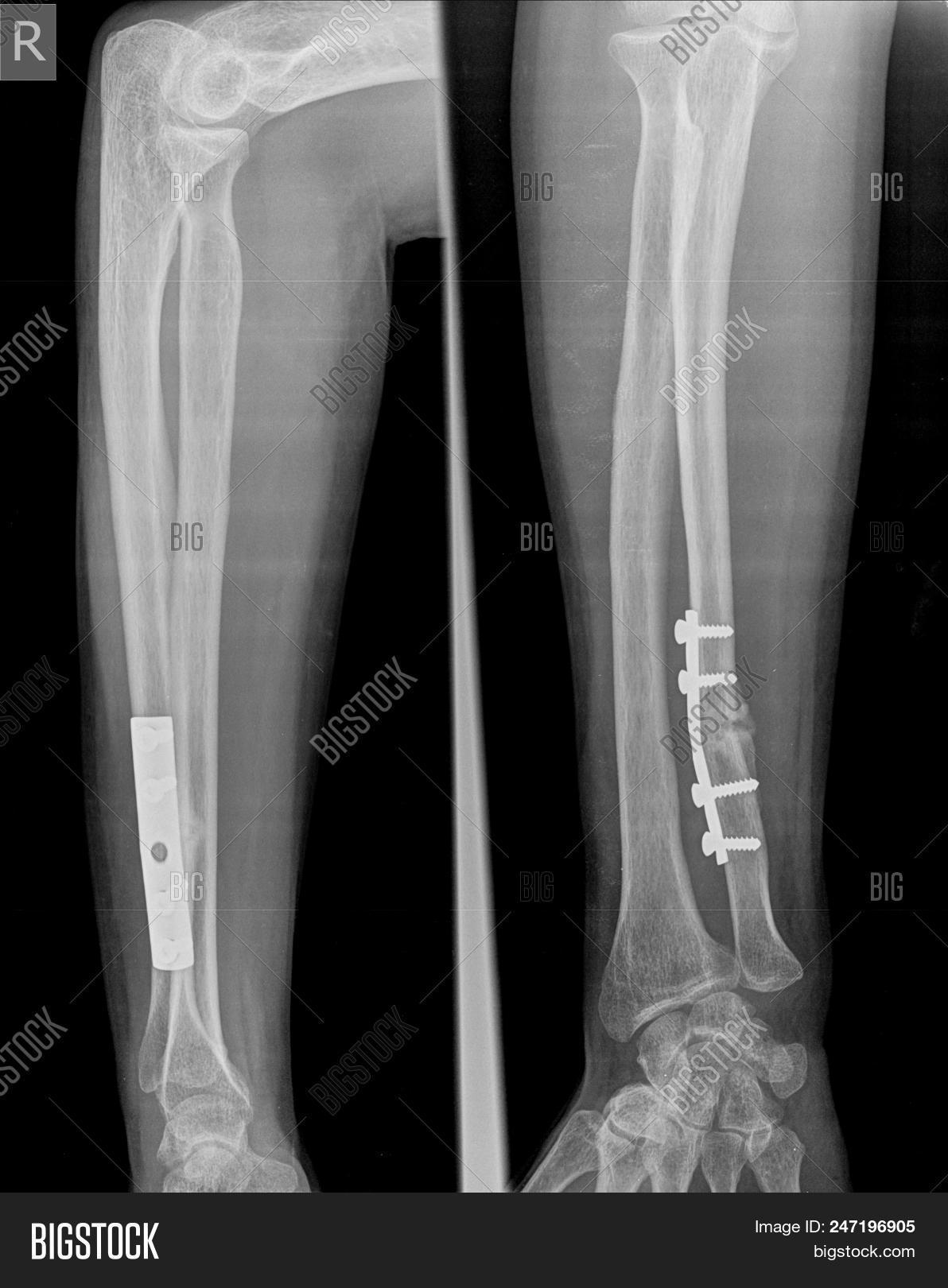 X-ray Forearm Show Post Operation Right Forearm With Plate And Screw ...