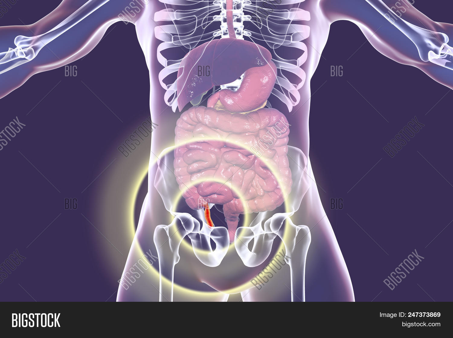 Acute Appendicitis, 3d Illustration Showing Inflammed Appendix Inside Human Body image & stock ...