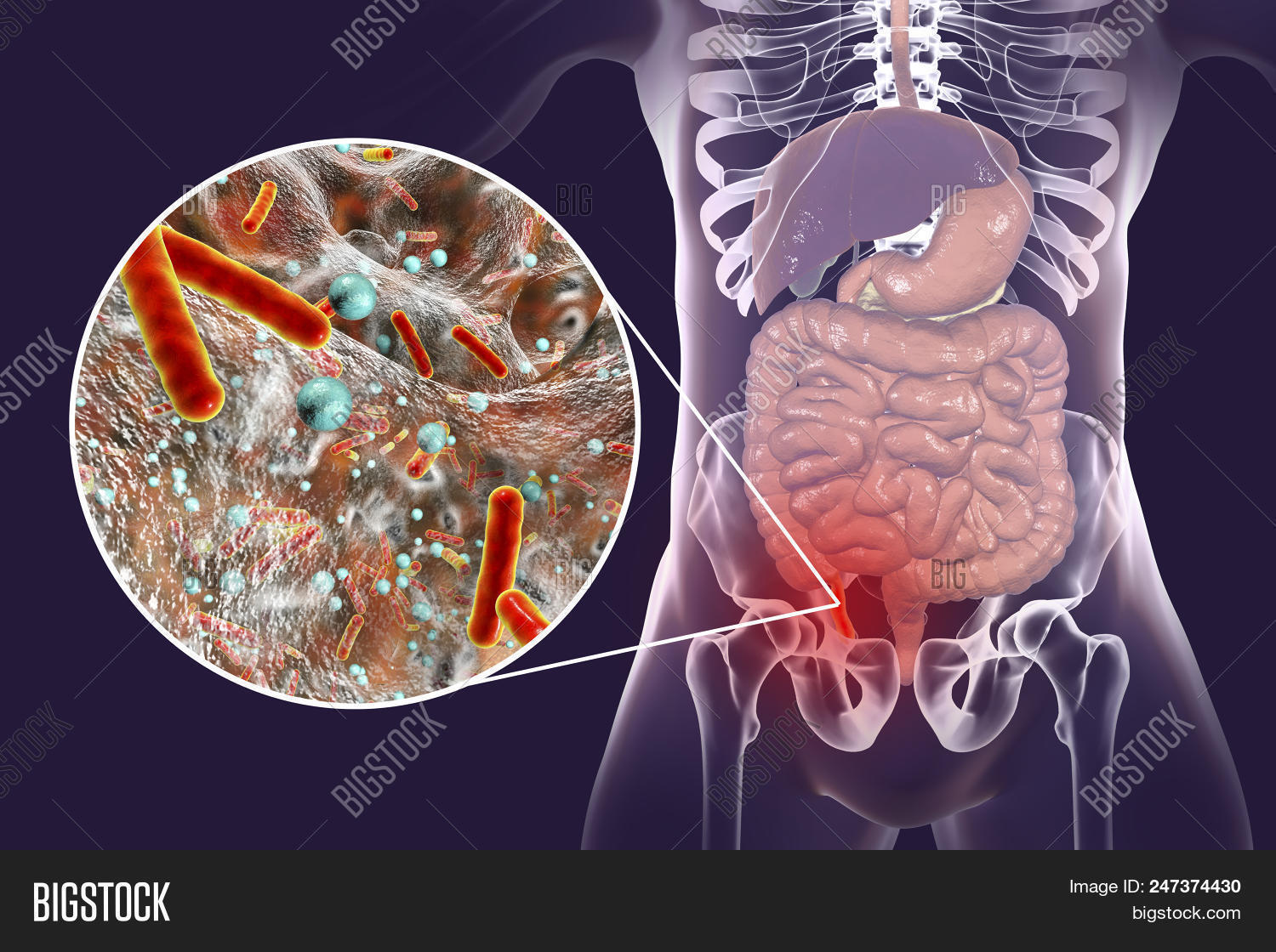 Acute Appendicitis And Close-up View Of Bacteria In Appendix, The ...