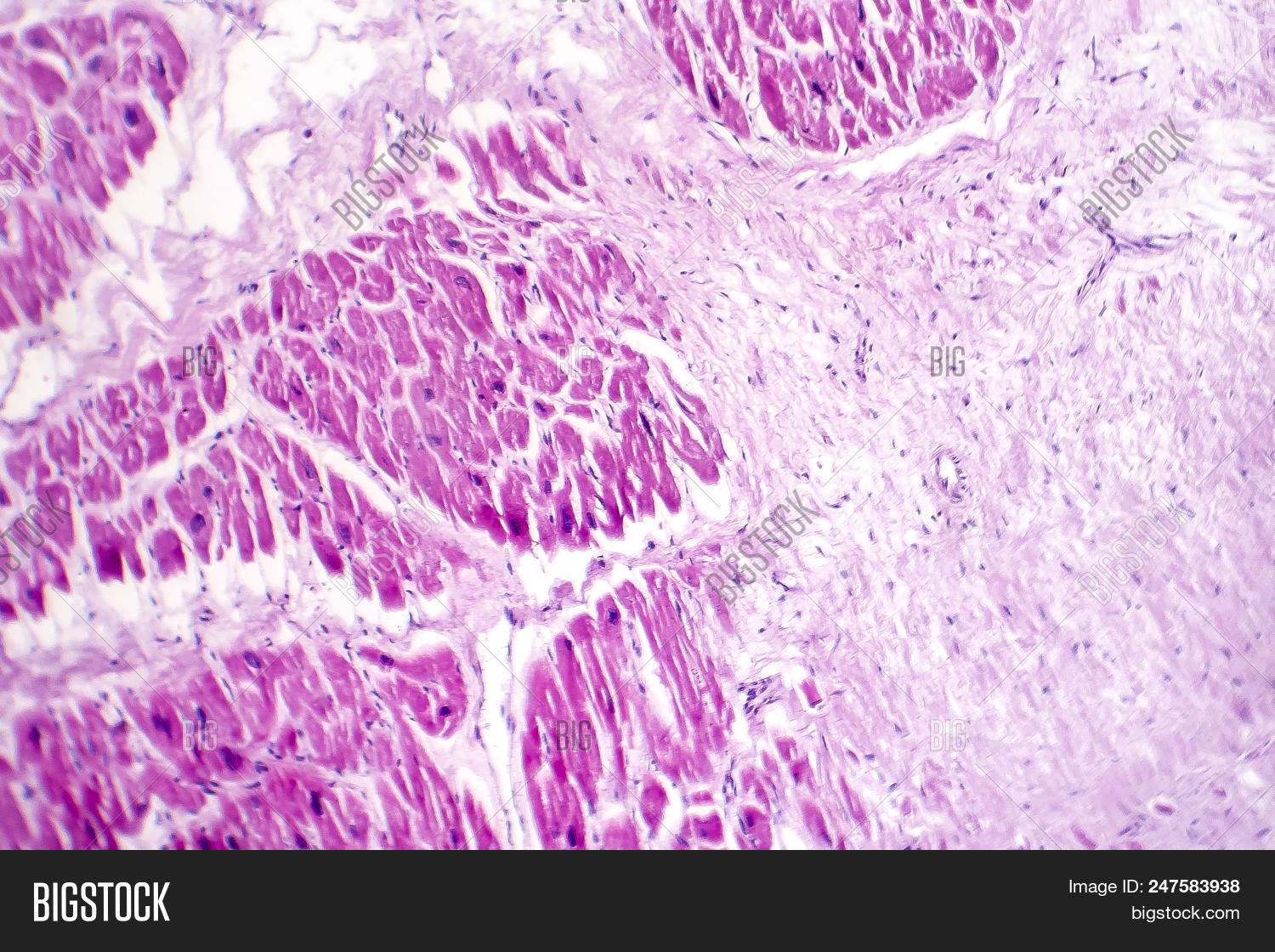 Acute Myocardial Infarction, Histology Of Heart Tissue, Light ...