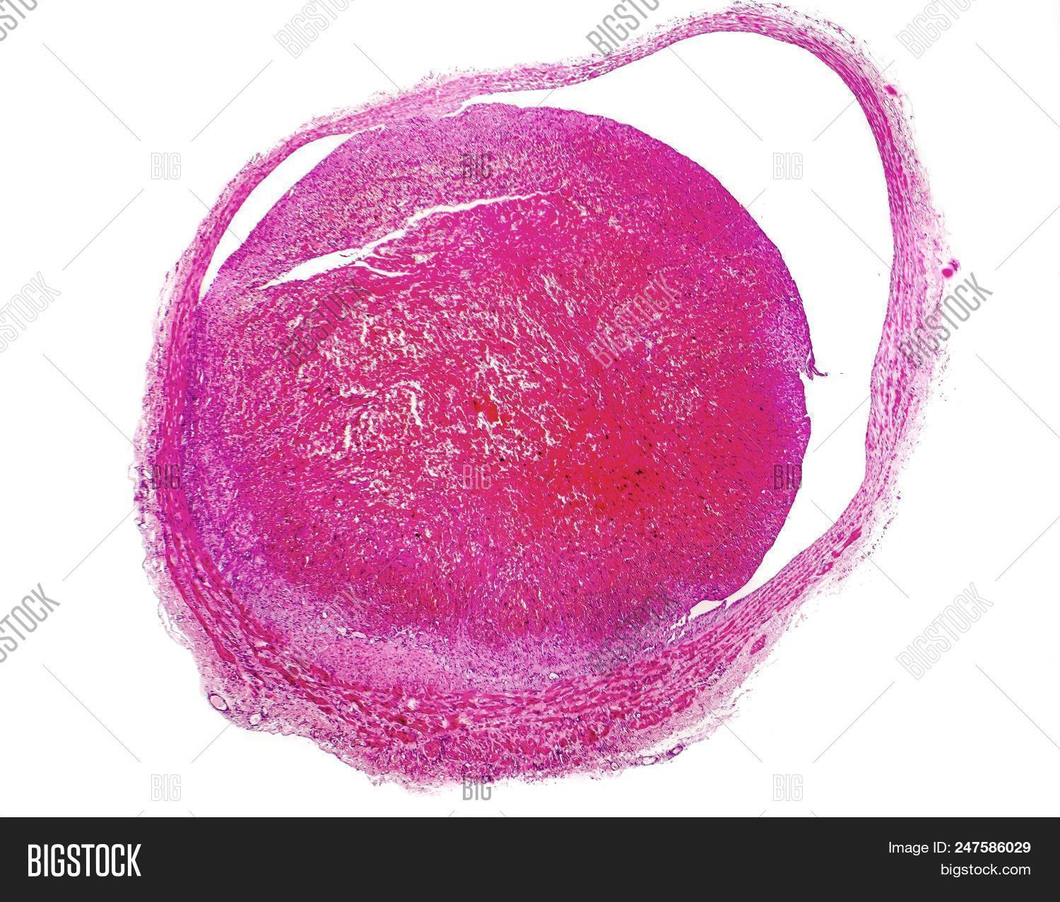 Thrombus Inside Blood Vessel, Light Micrograph, Hematoxylin And Eosin ...