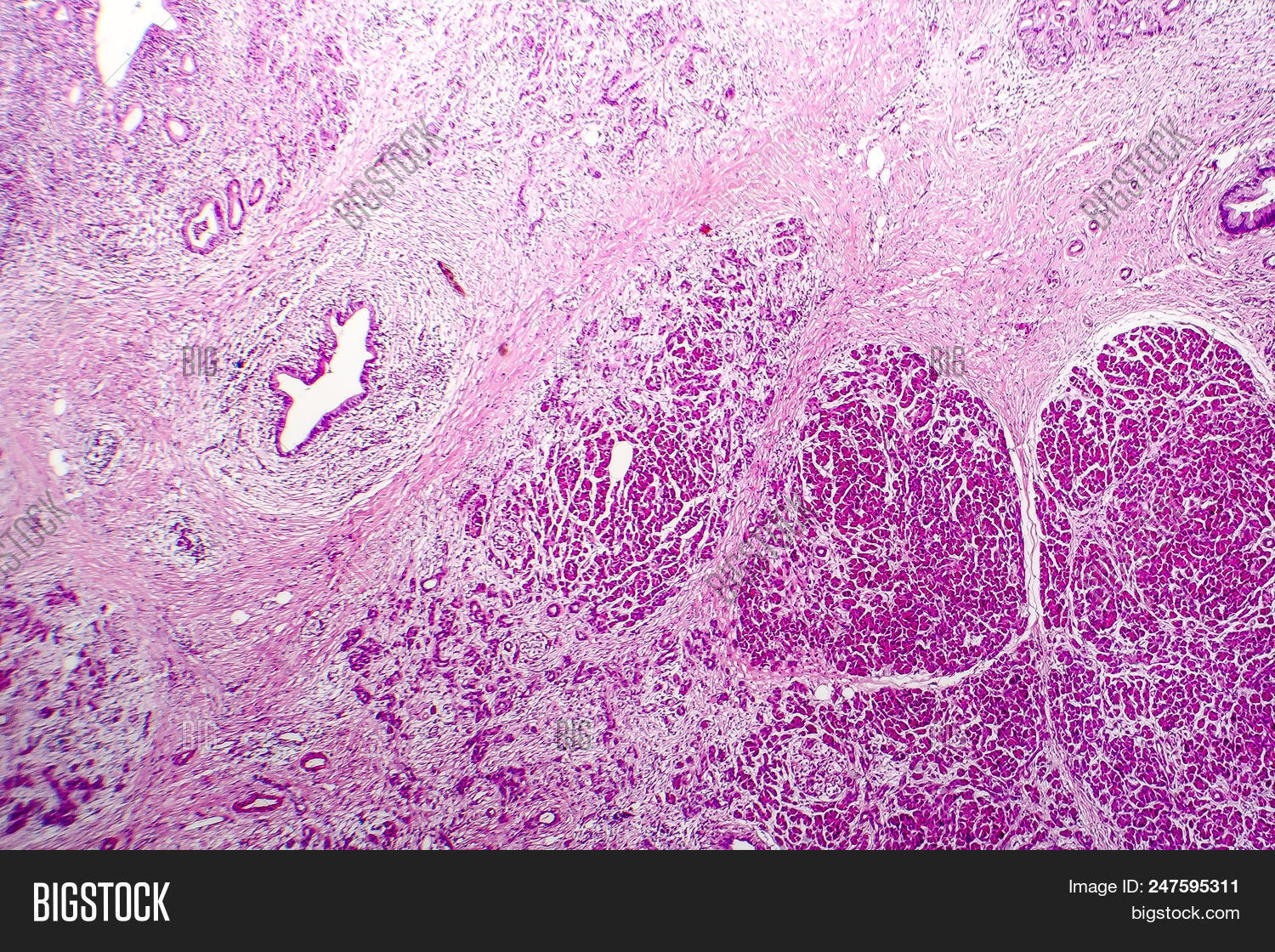 Acute Hemorrhagic Pancreatitis, Light Micrograph, Hematoxylin And Eosin ...