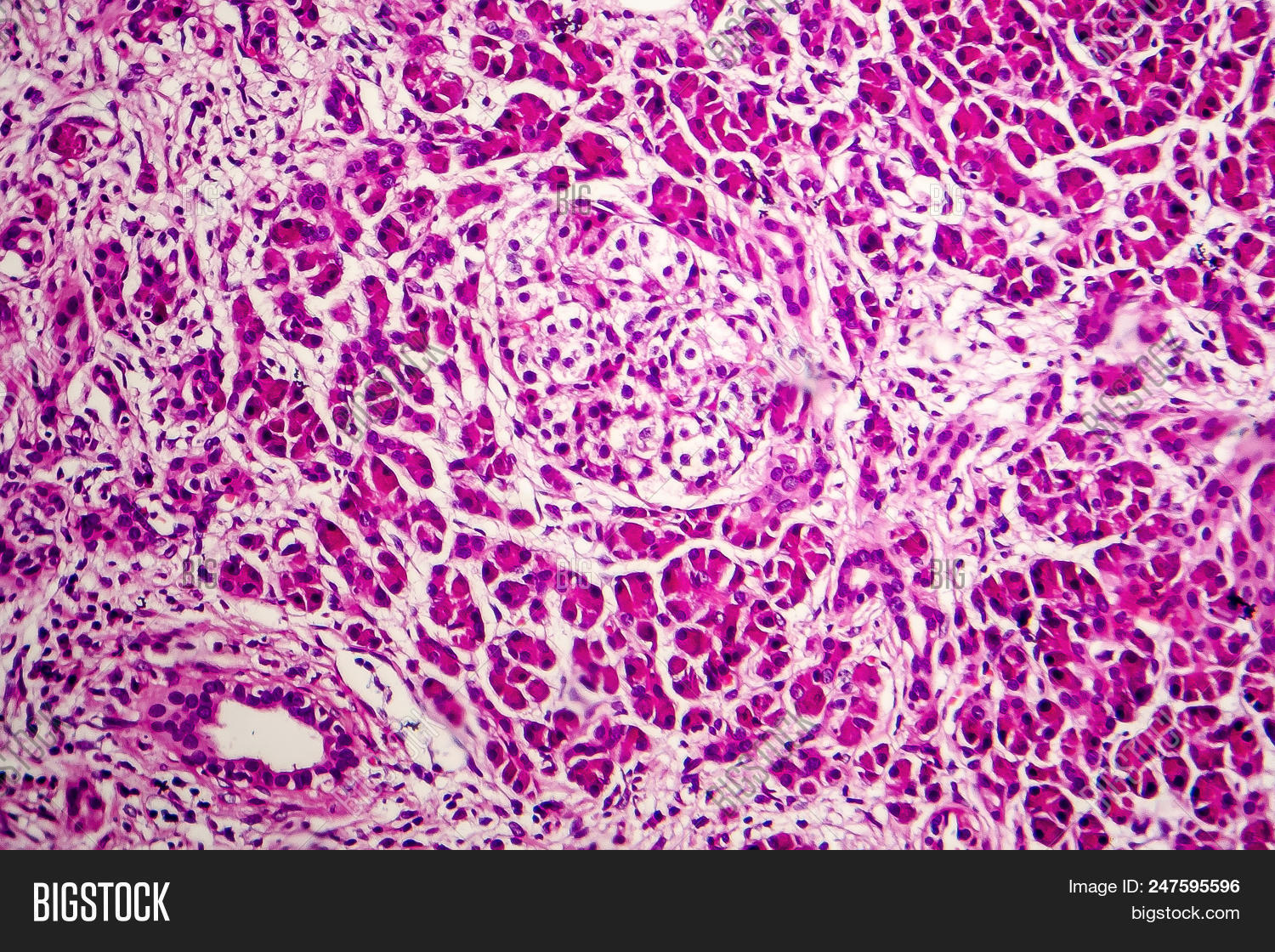 Acute Hemorrhagic Pancreatitis, Light Micrograph, Hematoxylin And Eosin ...
