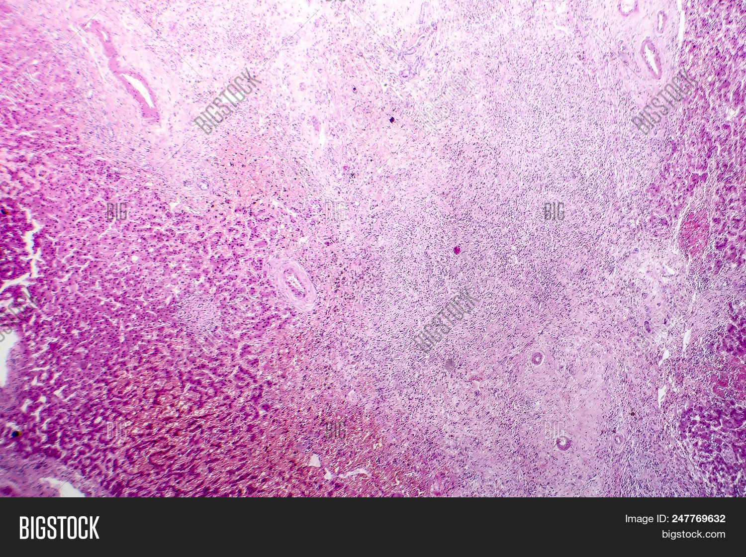 Histopathology Of Liver Abscess, Light Micrograph, Hematoxylin And ...
