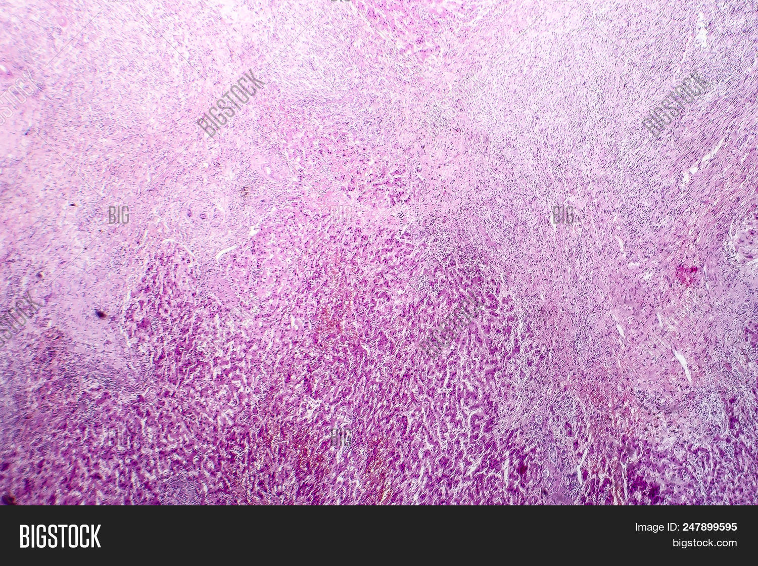 Histopathology Of Liver Abscess, Light Micrograph, Hematoxylin And ...
