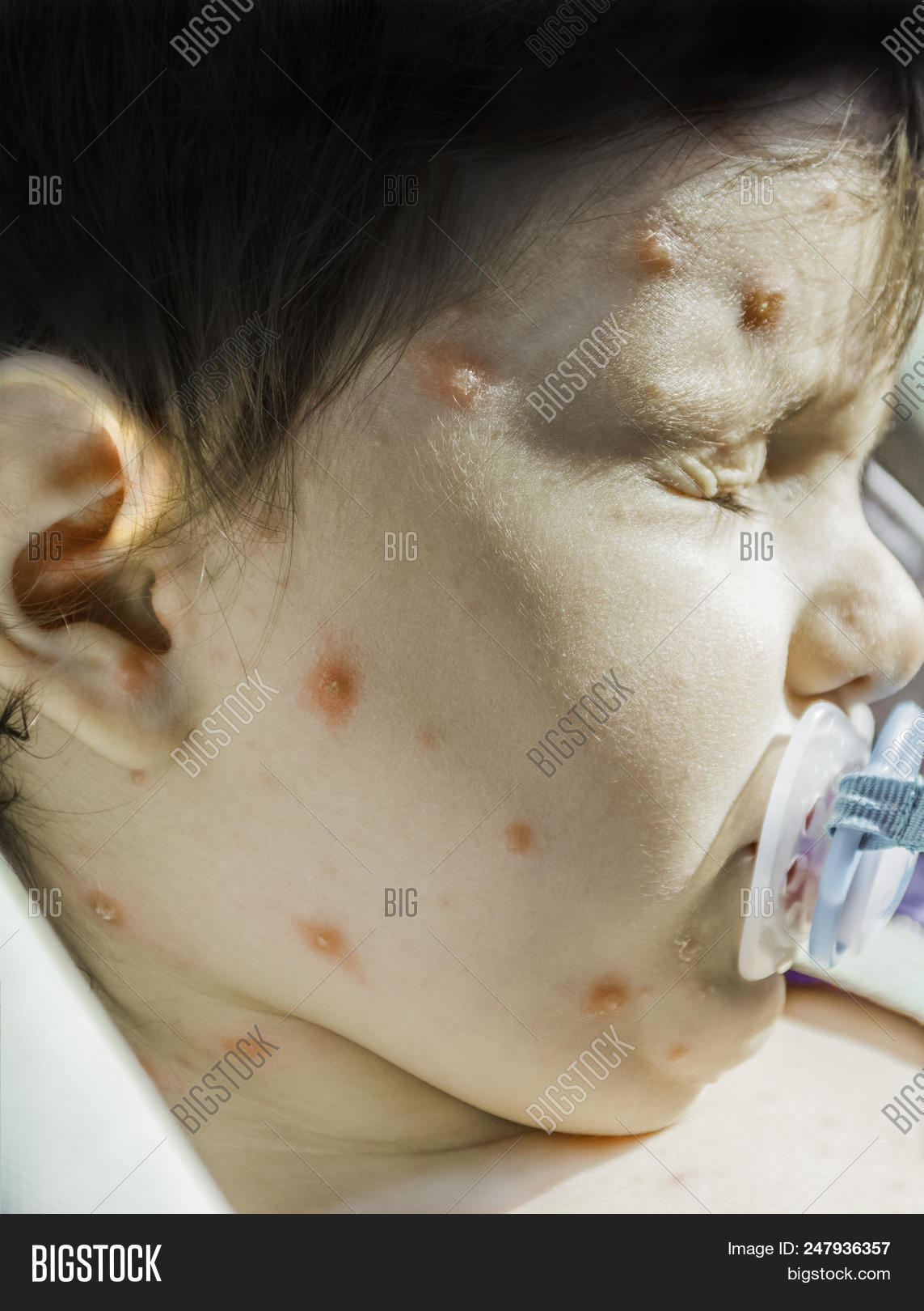 Close Up Shot Of Varicella Virus Or Chicken Pox Bubble Rash And Blister ...