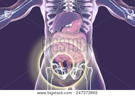 Acute Appendicitis, 3d Illustration Showing Inflammed Appendix Inside ...