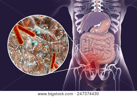 Acute Appendicitis And Close-up View Of Bacteria In Appendix, The ...