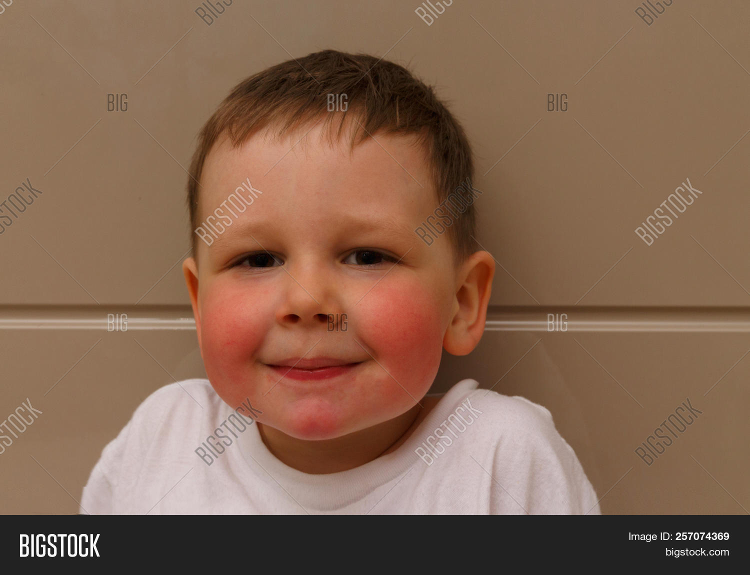 The Boy Has Red Cheeks, A Rash On His Cheeks In The Child, A Rash On ...