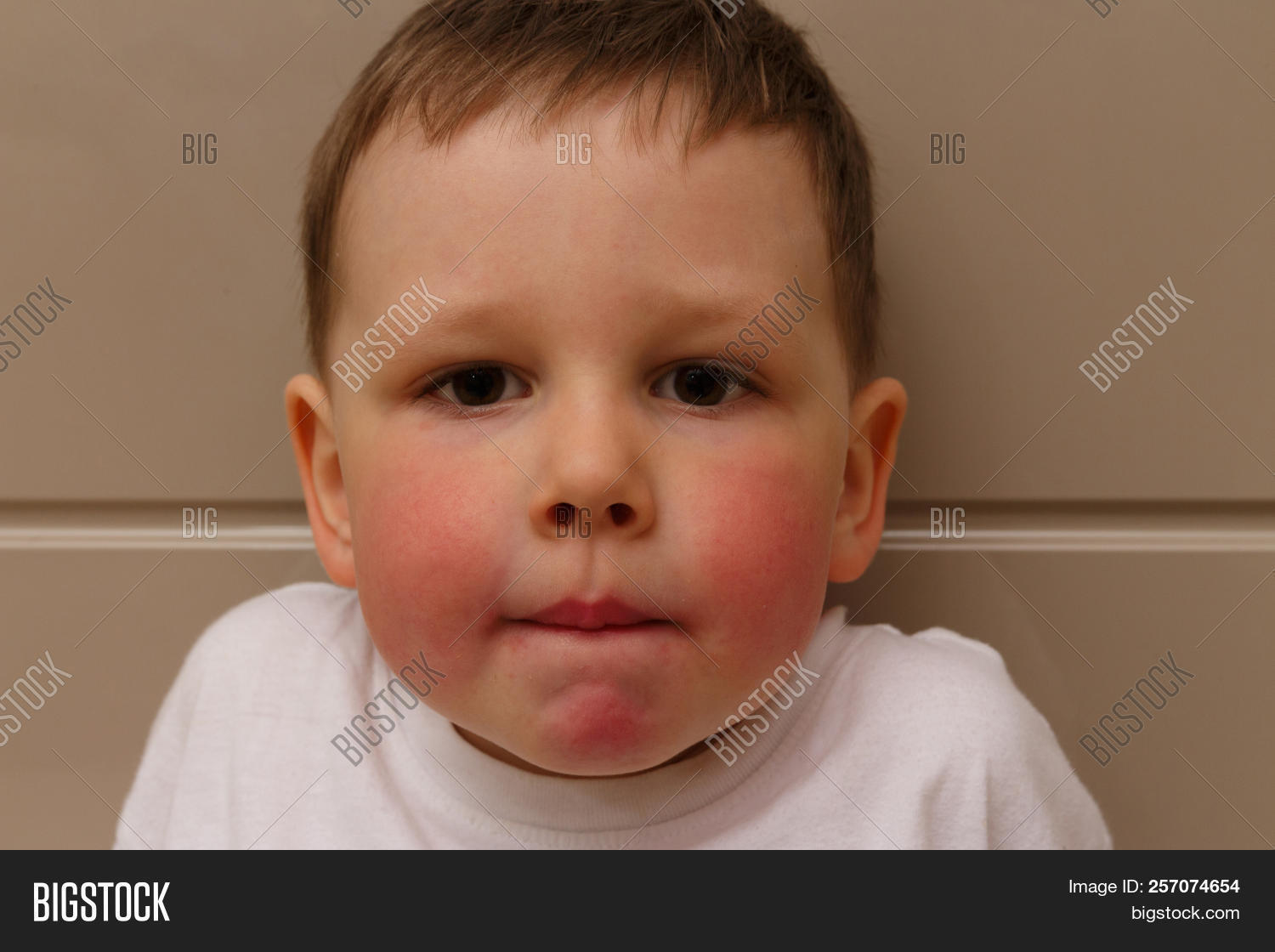 The Boy Has Red Cheeks, A Rash On His Cheeks In The Child, A Rash On ...