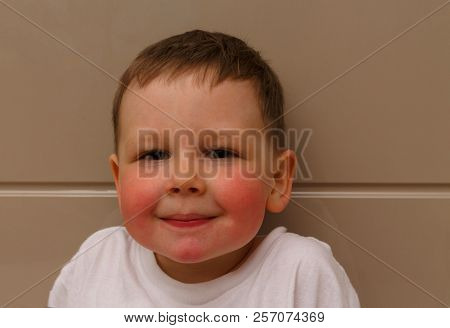 The Boy Has Red Cheeks, A Rash On His Cheeks In The Child, A Rash On ...