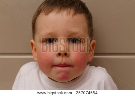 The Boy Has Red Cheeks, A Rash On His Cheeks In The Child, A Rash On ...